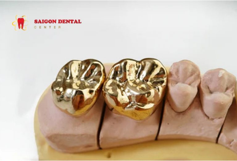 Gold Dental Crown: Benefits - Procedure - Cost - Saigon Center Dental ...