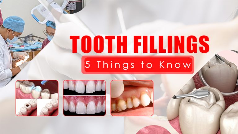 Tooth Fillings - 5 Things To Know - Saigon Center Dental Clinic