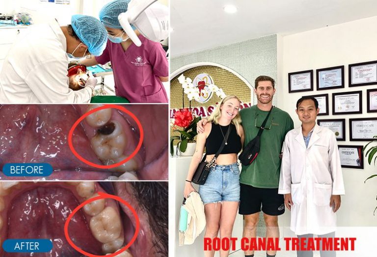 Painless Root Canal Treatment in Vietnam | Expert Dental Care - Saigon Center Dental Clinic