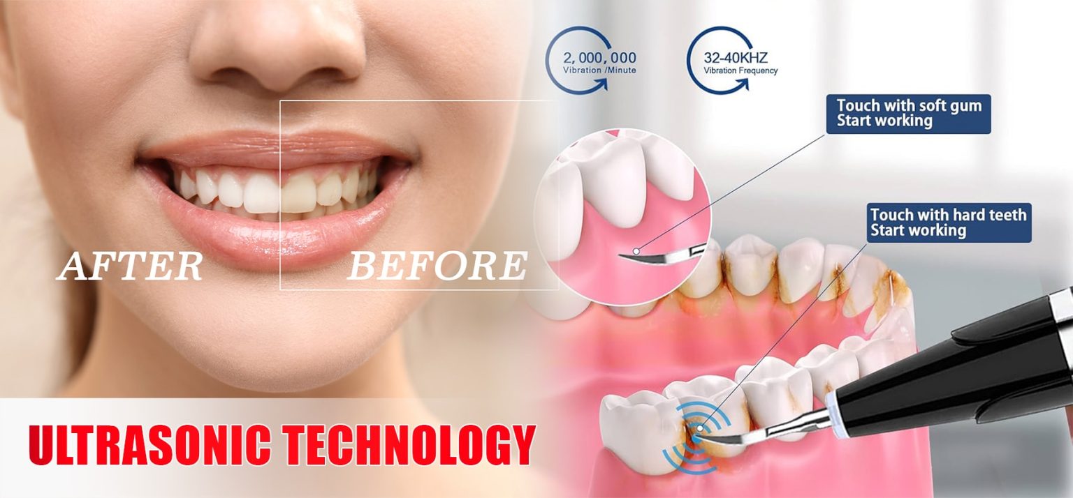 Understanding And Managing Black Tartar On Teeth - Saigon Center Dental ...