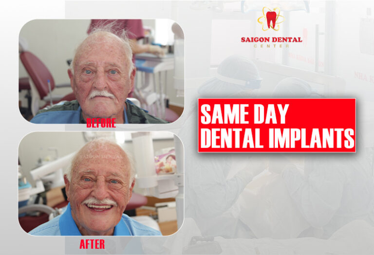 One Day Dental Implants Near Me - Saigon Center Dental Clinic