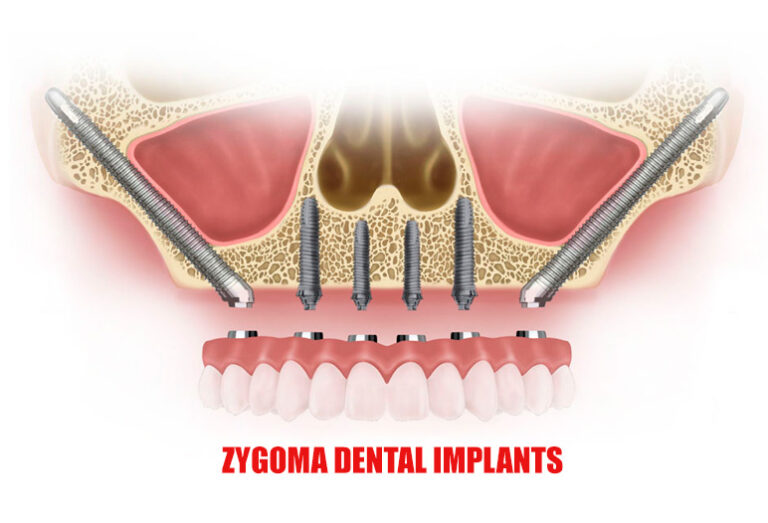 What Are Zygomatic Dental Implants? - Saigon Center Dental Clinic