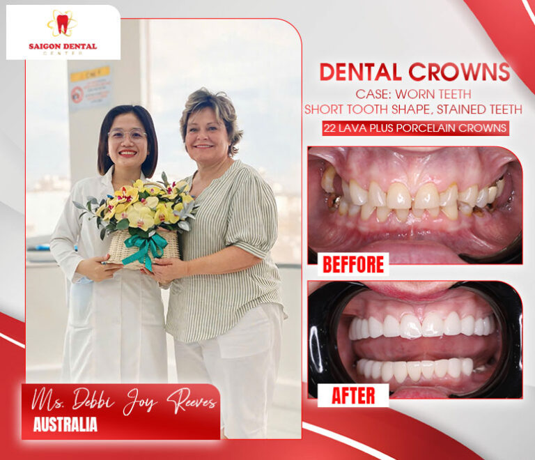 Affordable Dental Crown In Ho Chi Minh City – Durable & Aesthetic ...